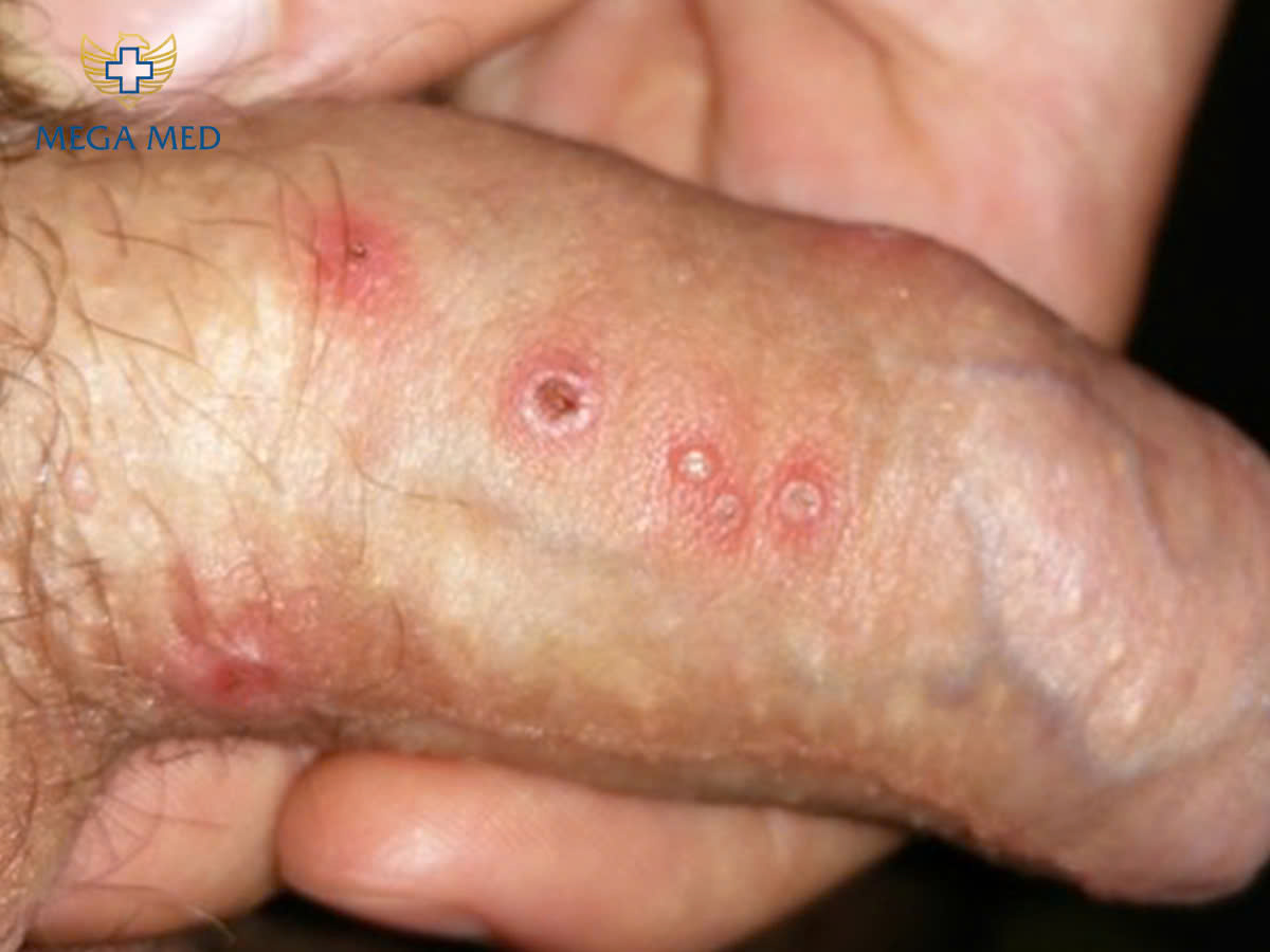 Cách phân biệt mụn rộp sinh dục và sùi mào gà